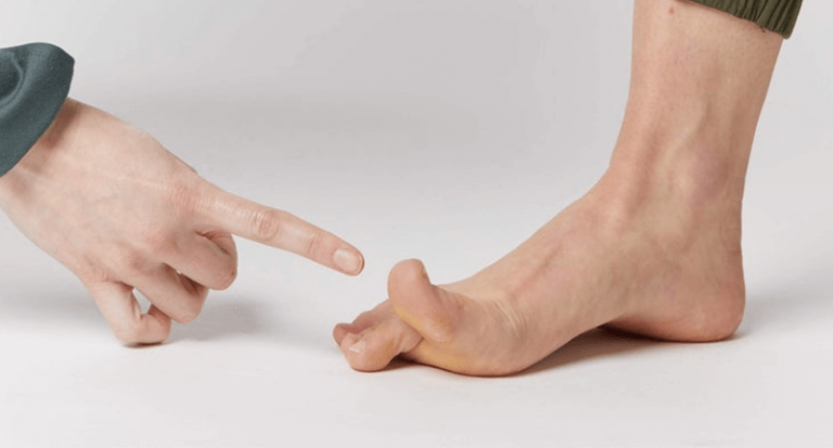 How To Fix High Arches: Doctor’s Advice In 2023